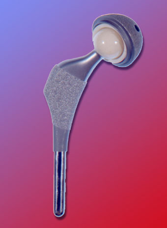 Lateral Flare Hip Prosthesis | Joseph F. Fetto, M.D. | Orthopaedic Surgery